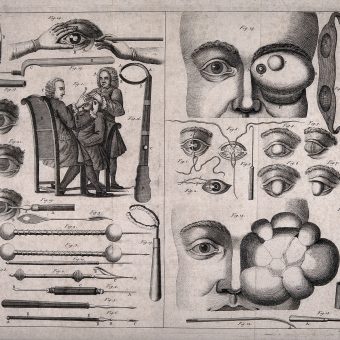 Ophthalmology instruments, eye growths, a cataract operation and other ...